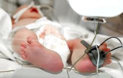 Umbilical Cord Around Neck Death